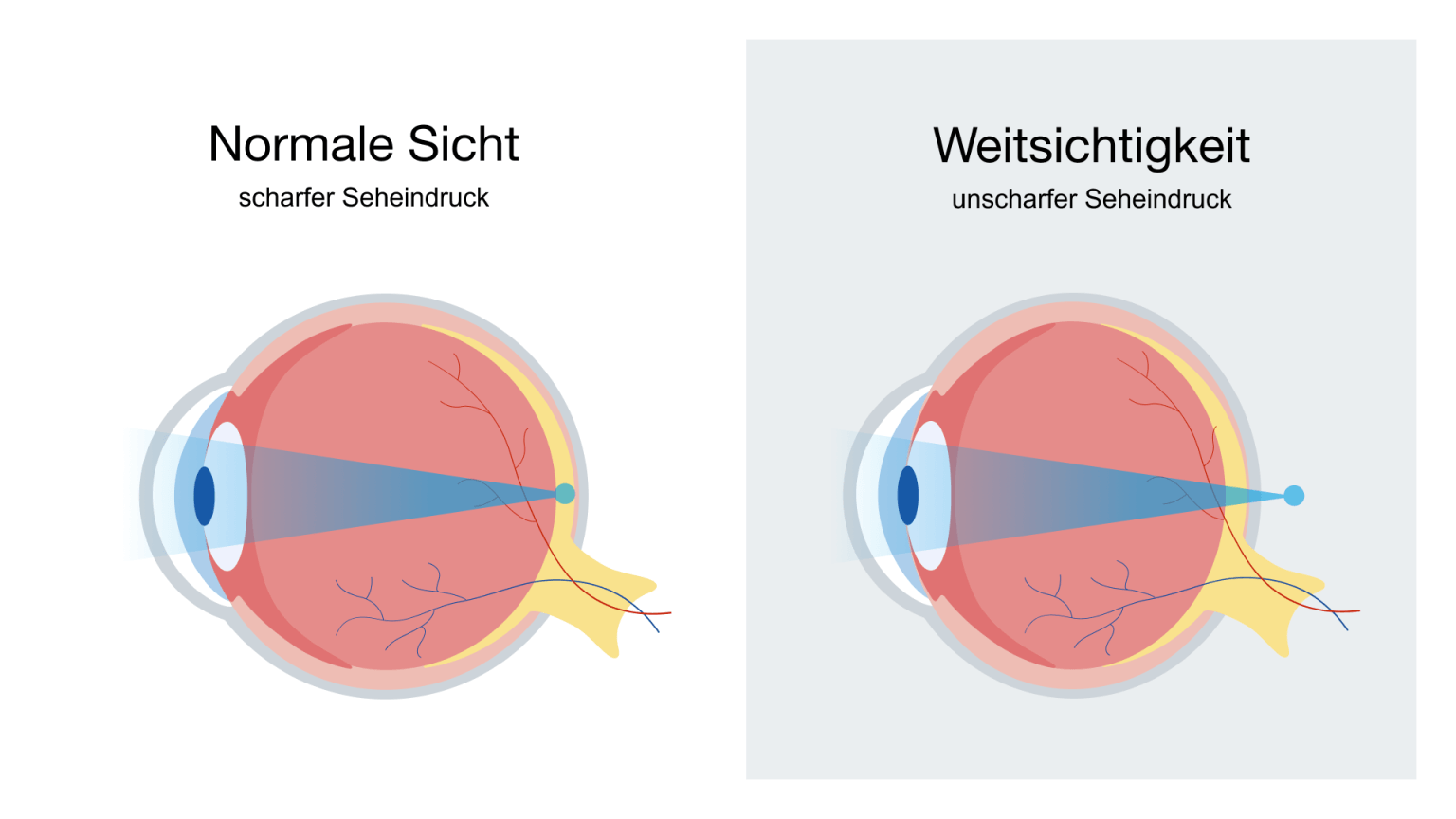 Unterschiede zwischen Alterssichtigkeit und Weitsichtigkeit